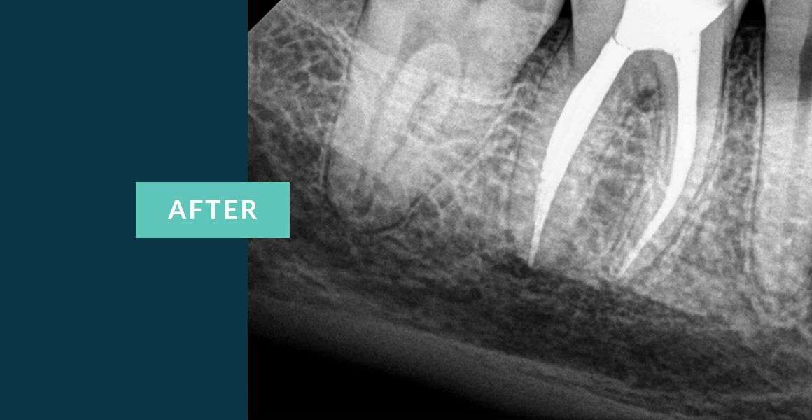 Root Canal Before And Afters Midtown Endodontist Nyc
